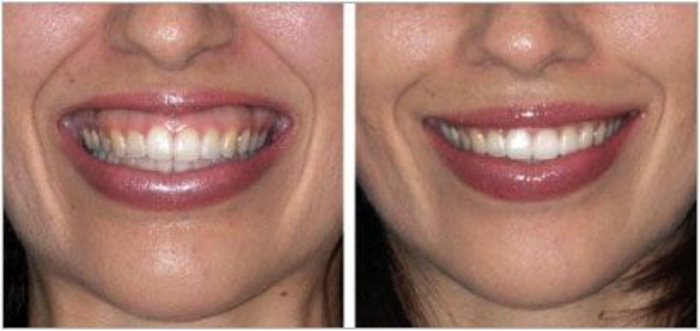 Difference between fillings vs inlays vs onlays vs crowns | Miners ...